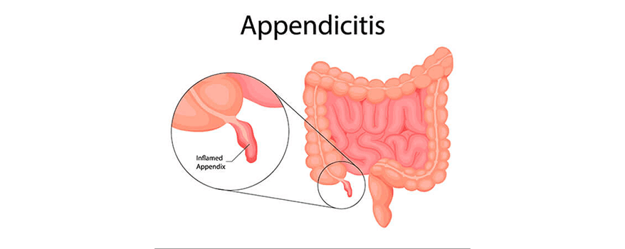 Infected Appendix Acute Appendicitis: Review And Update | AAFP